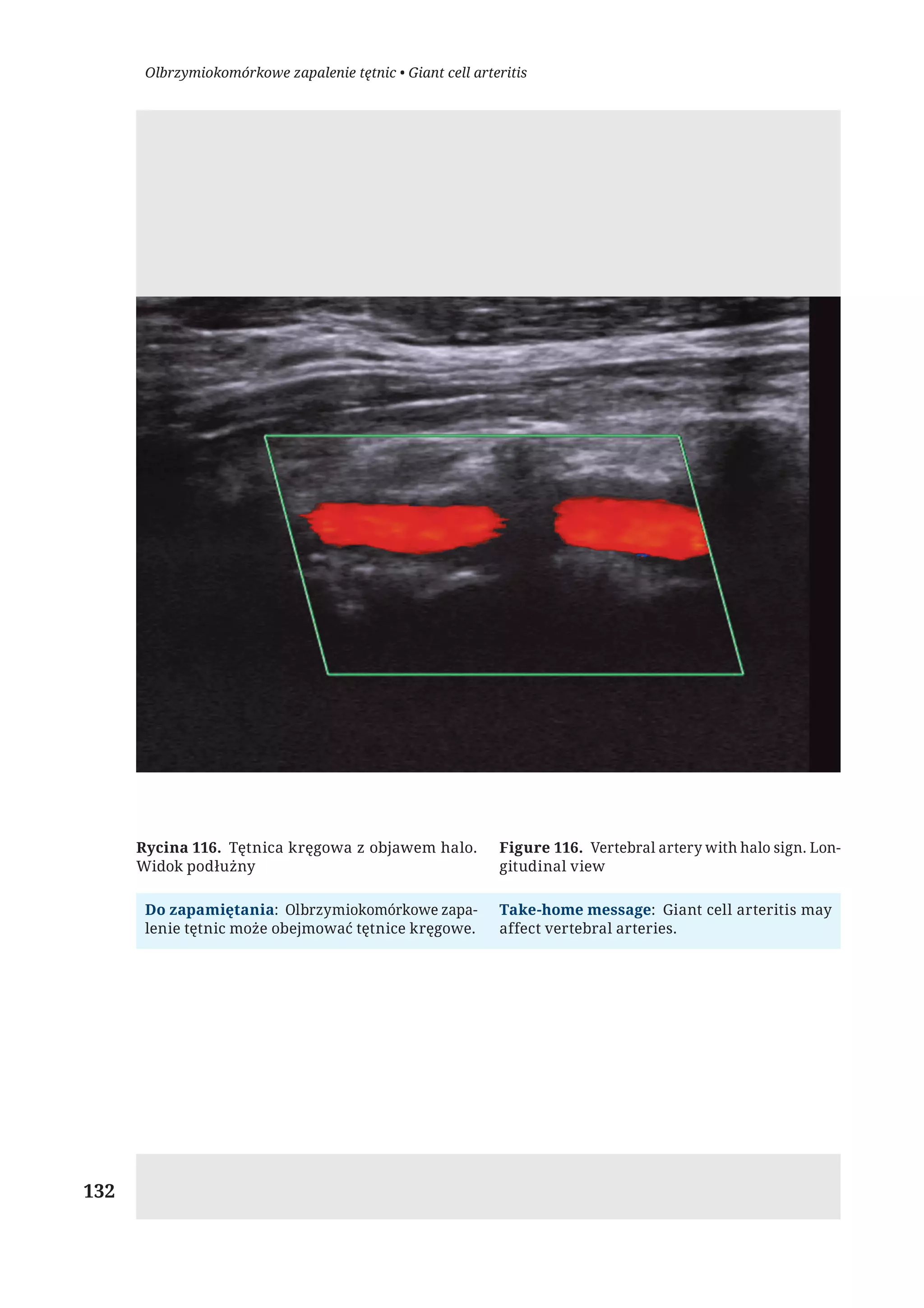 Sample atlas of ultrasound application in large vessel vasculitis giant ...