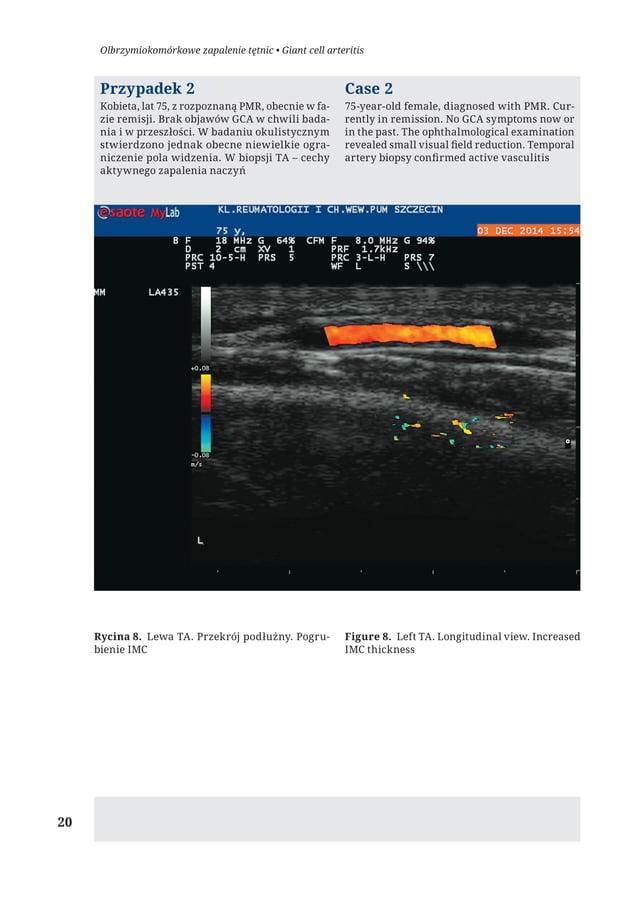 Sample atlas of ultrasound application in large vessel vasculitis giant ...