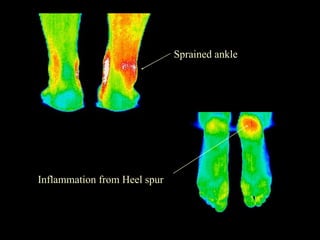 THERMOGRAM EXAMPLE IMAGES WITH EXPLANATIONS | PPT