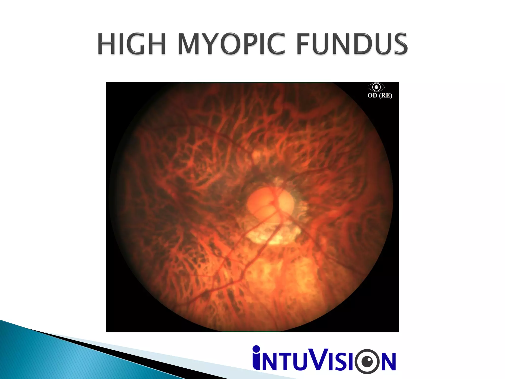 Sample Retinal Images | PDF