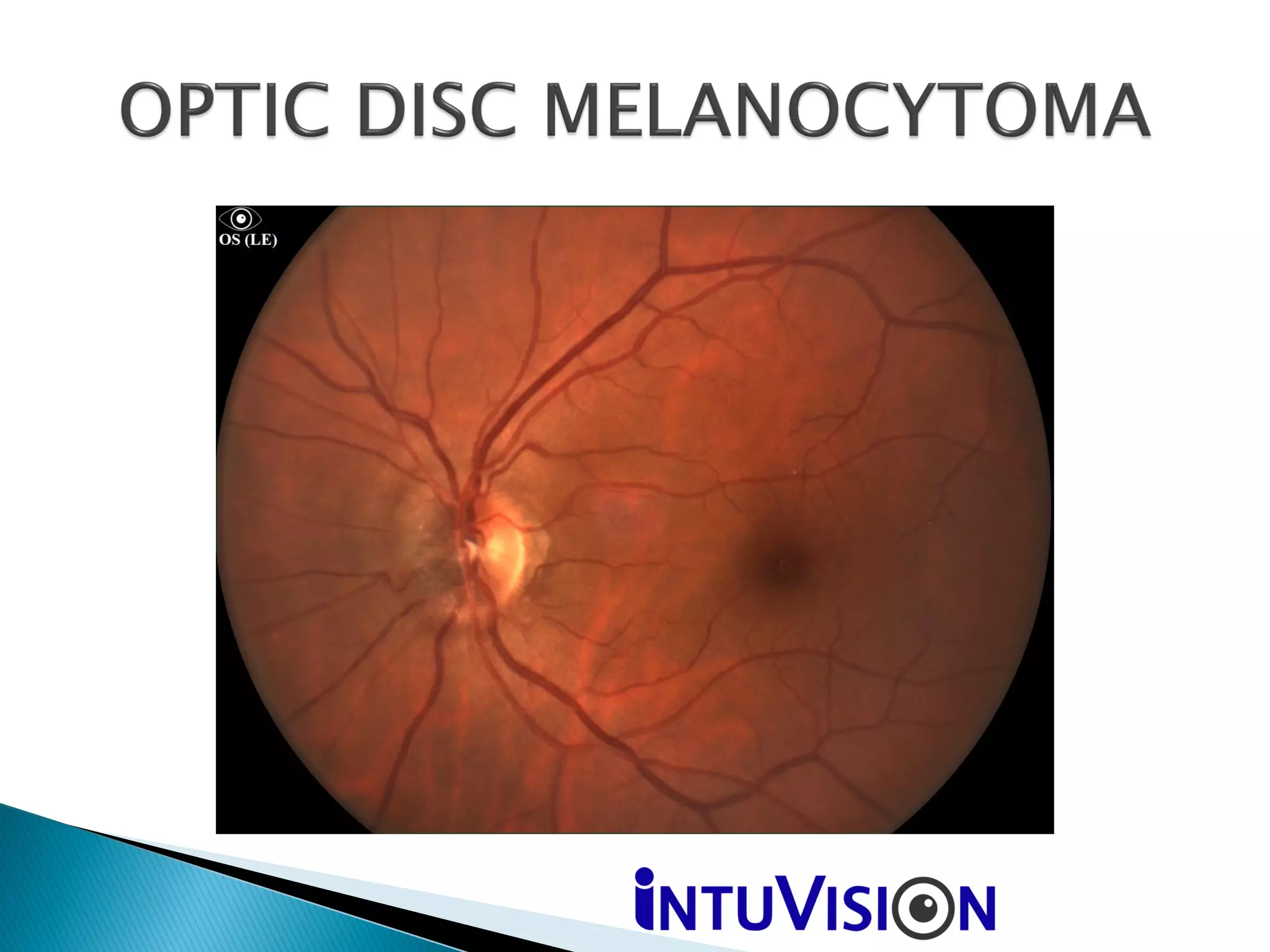 Sample Retinal Images | PDF