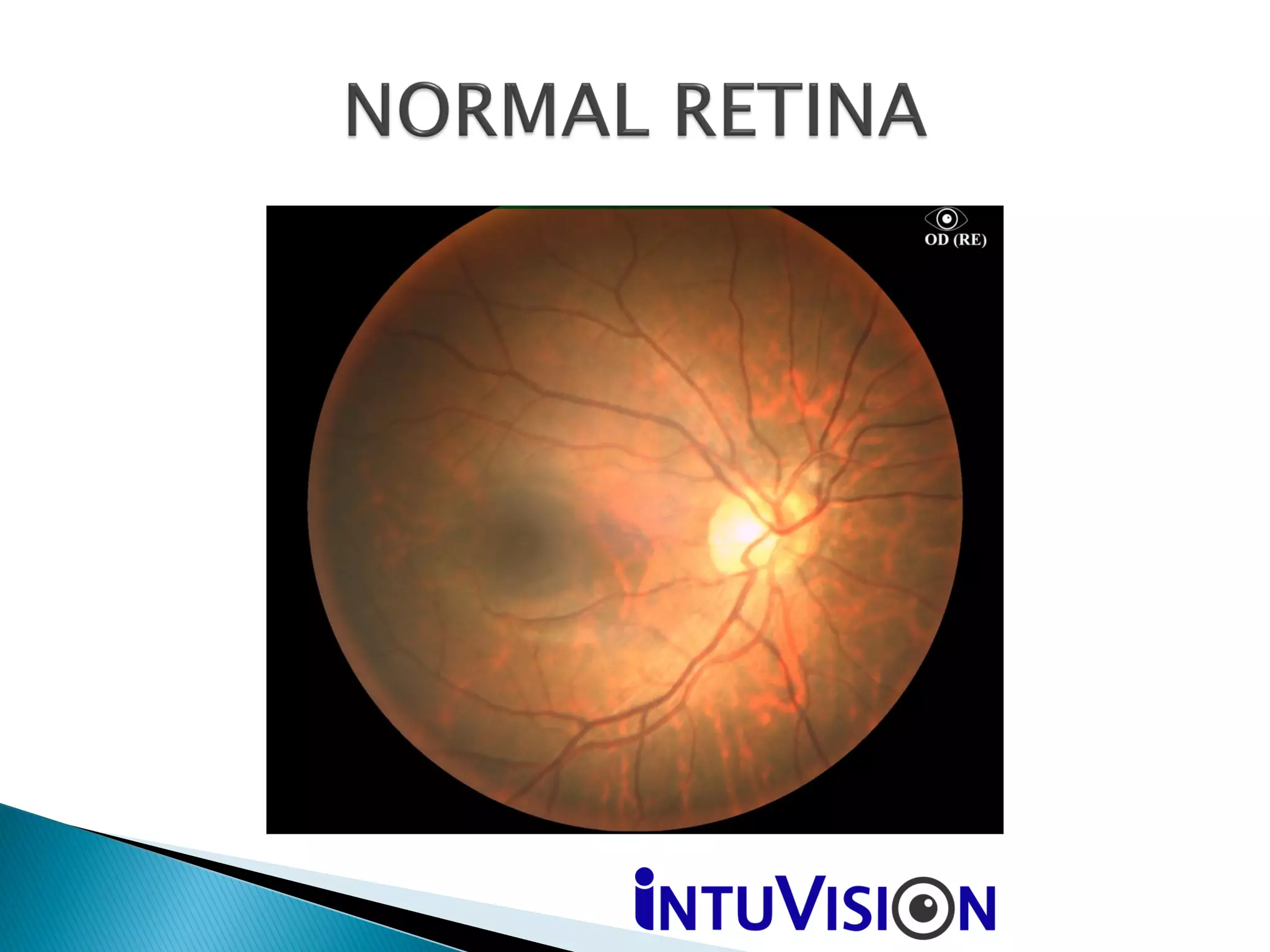 Sample Retinal Images | PDF