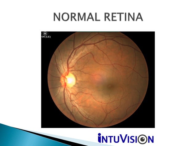 Sample Retinal Images | PDF | Eye and Vision Conditions | Diseases and ...