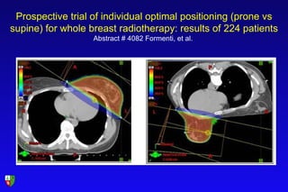 San Antonio Breast Cancer Symposium 2007 Highlights – Radiotherapy | PPT