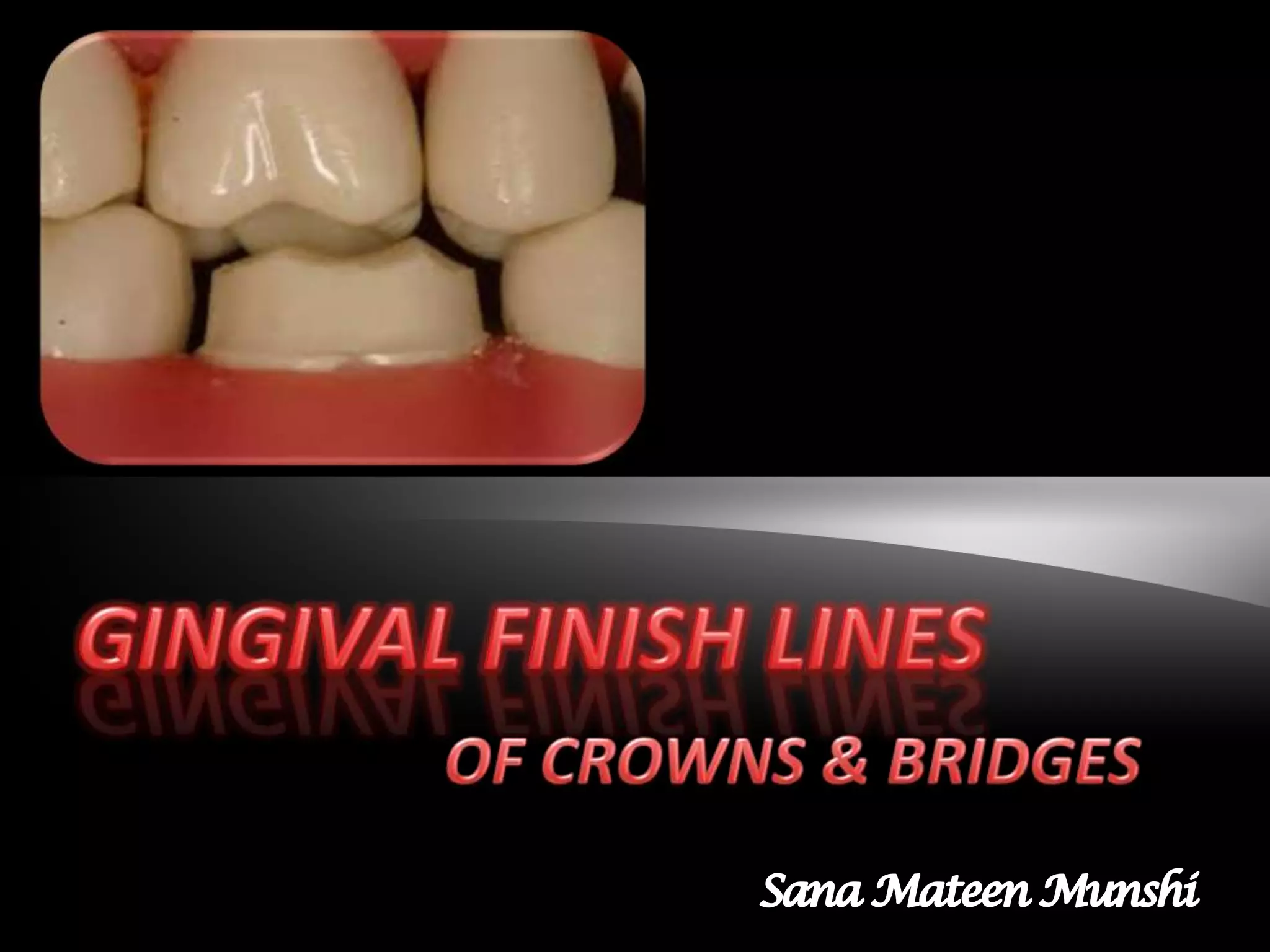 Different gingival finish lines (margins) of crowns and bridges | PPTX