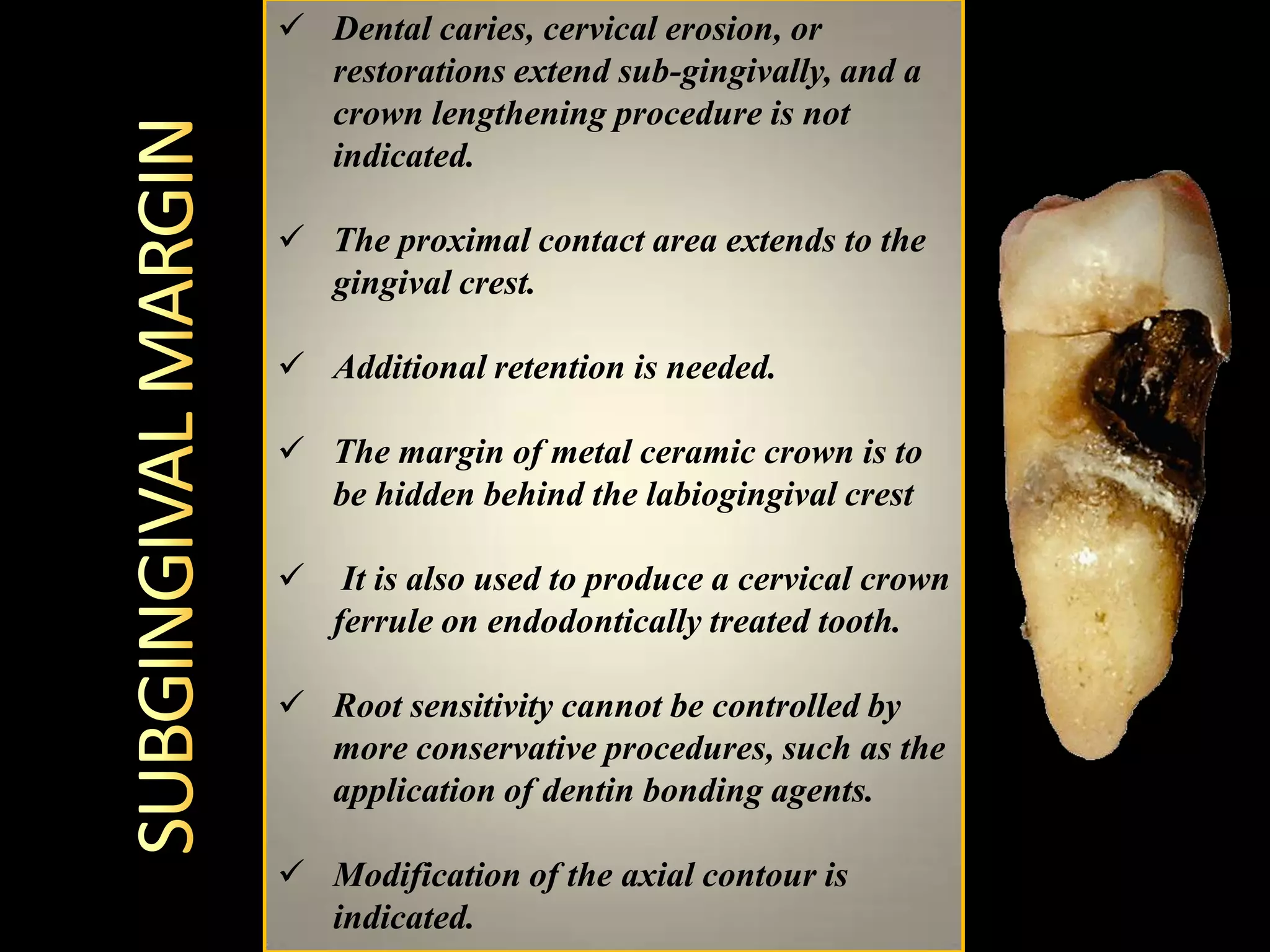 Different gingival finish lines (margins) of crowns and bridges | PPTX