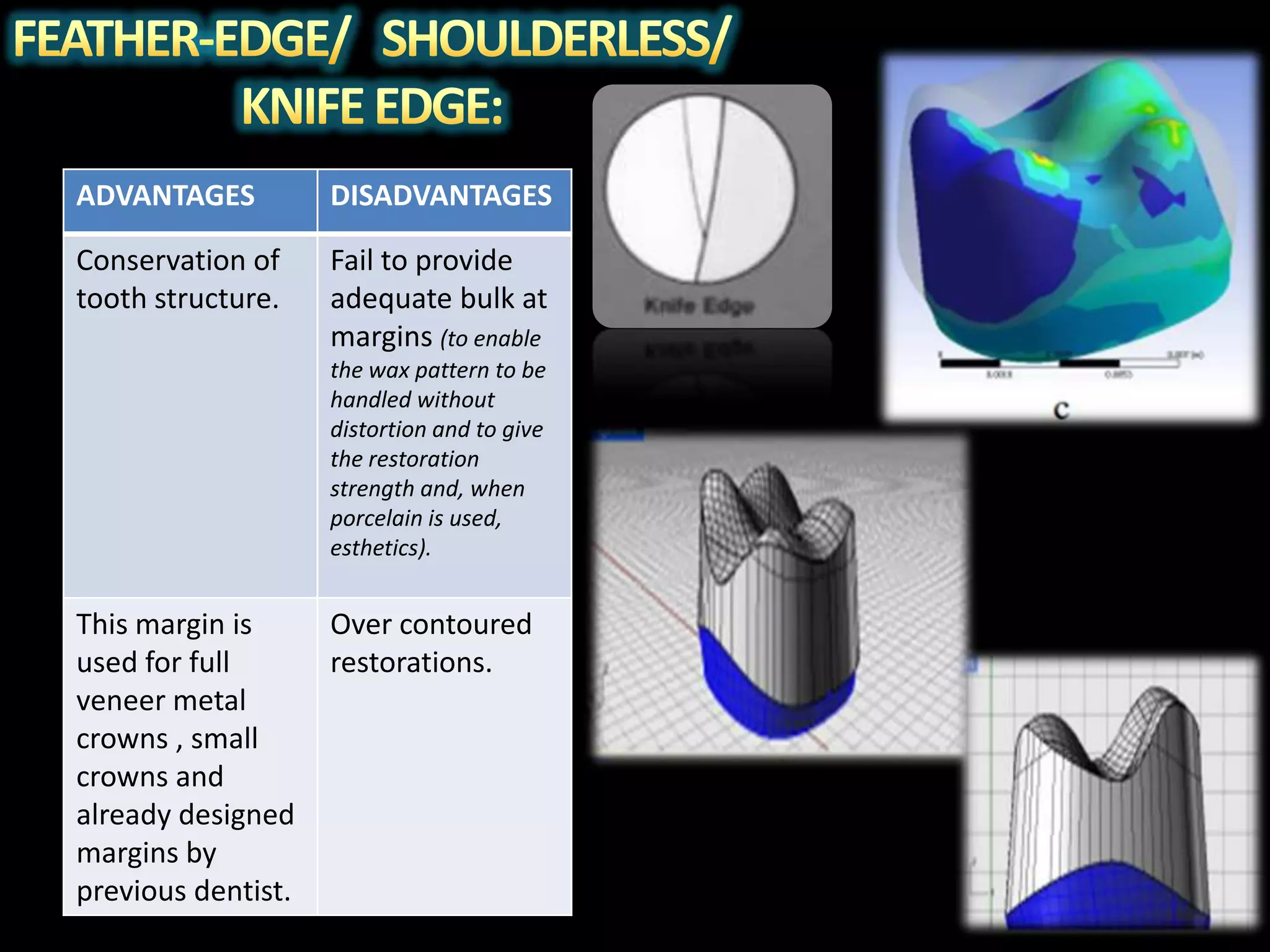 Different gingival finish lines (margins) of crowns and bridges | PPTX