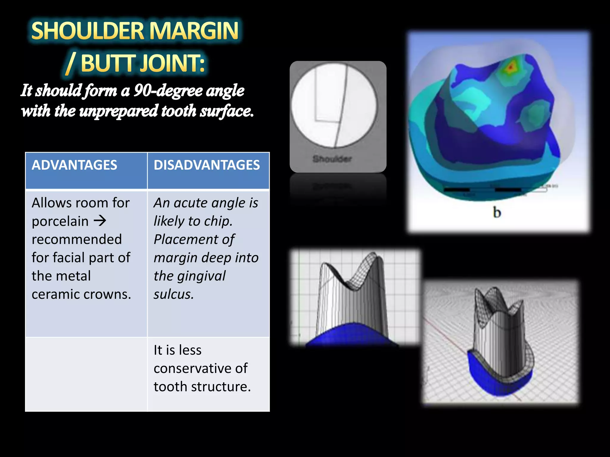 Different gingival finish lines (margins) of crowns and bridges | PPTX