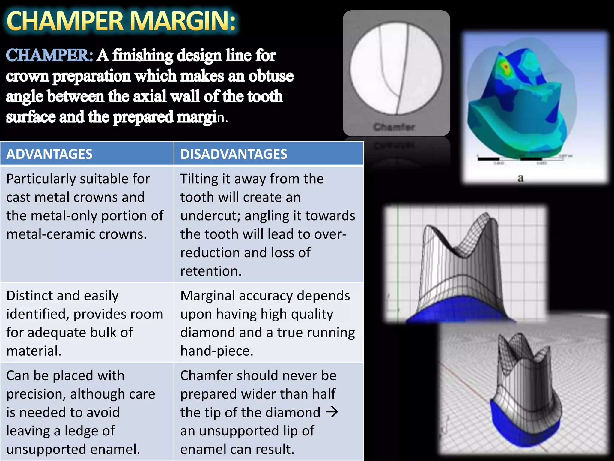 Different gingival finish lines (margins) of crowns and bridges | PPTX