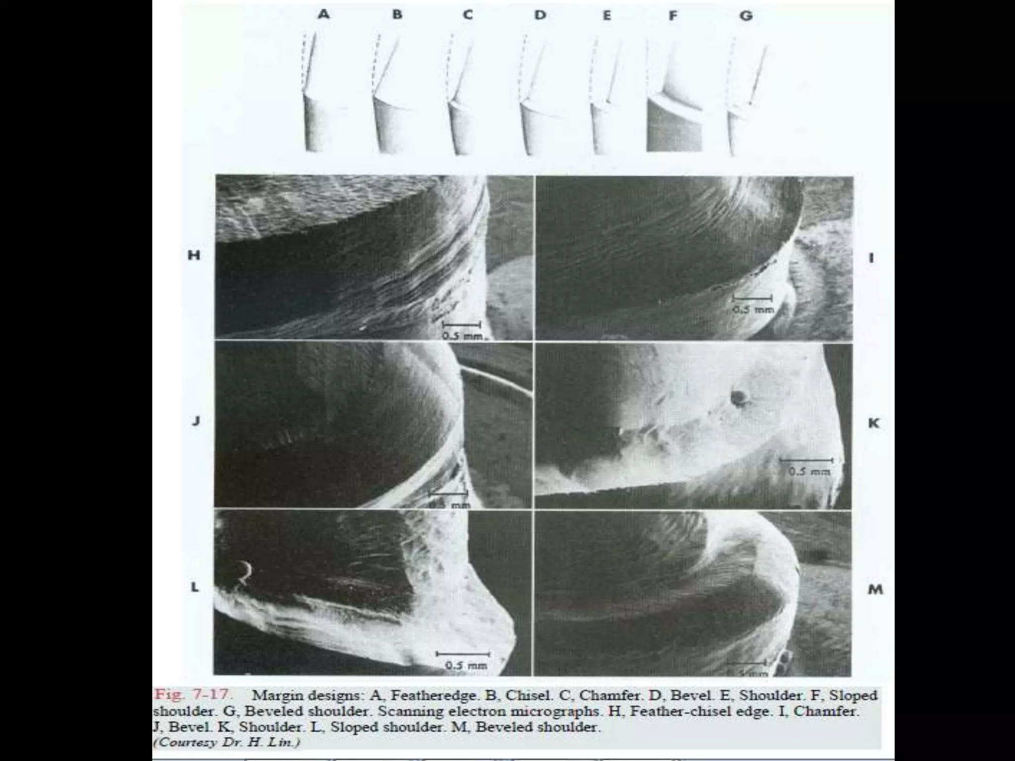 Different gingival finish lines (margins) of crowns and bridges | PPTX