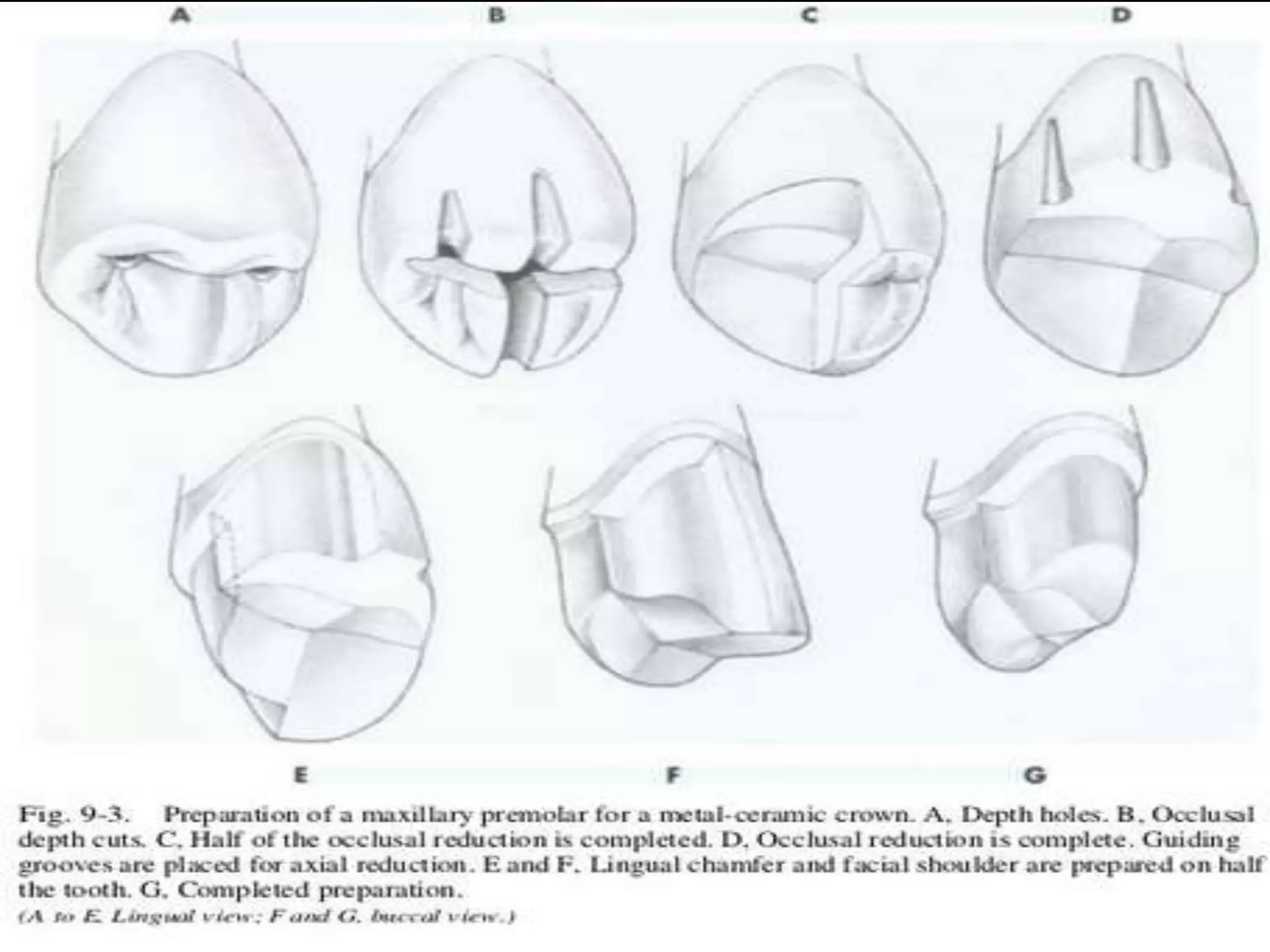 Different gingival finish lines (margins) of crowns and bridges | PPTX