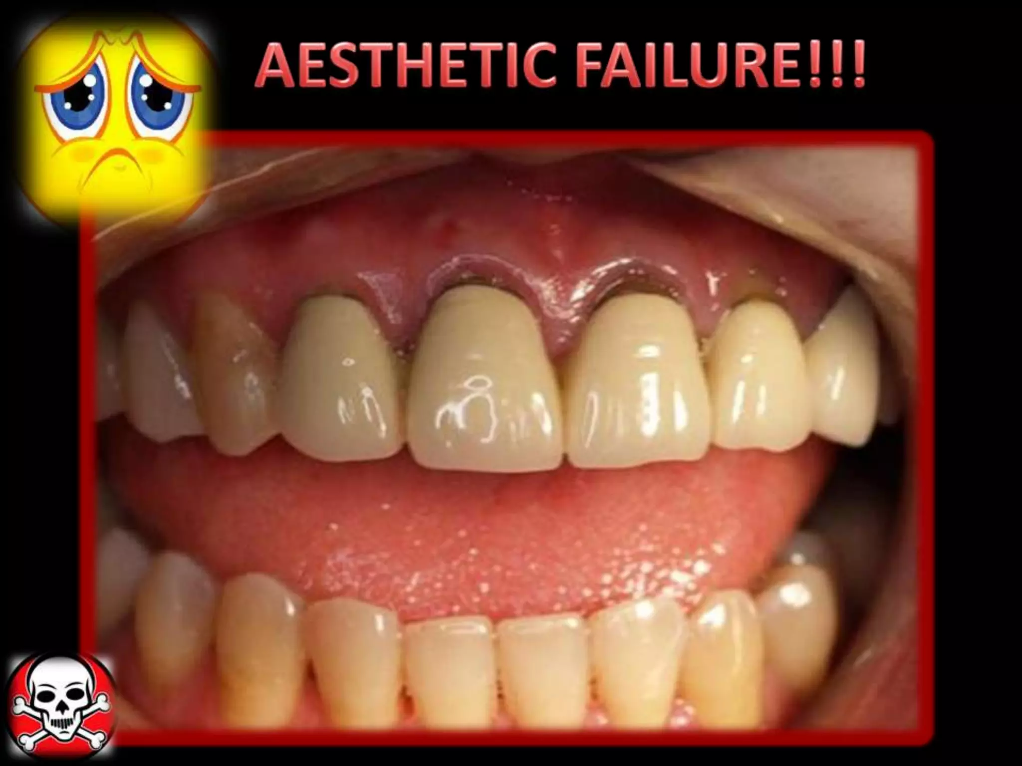 Different gingival finish lines (margins) of crowns and bridges | PPTX