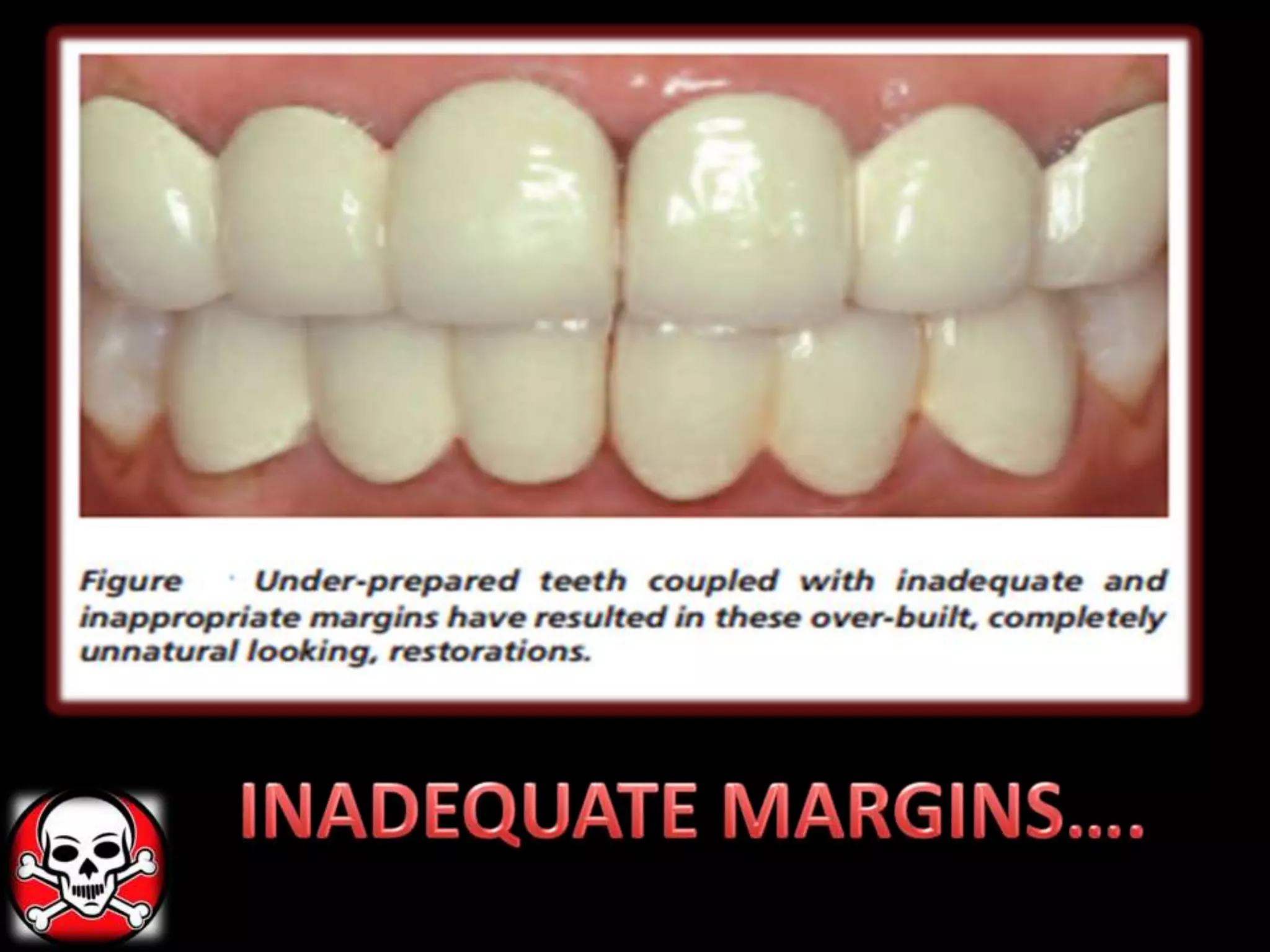 Different gingival finish lines (margins) of crowns and bridges | PPTX