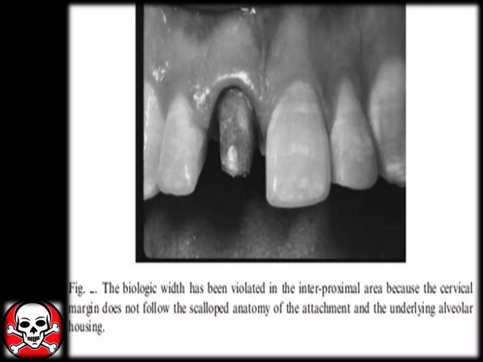 Different gingival finish lines (margins) of crowns and bridges | PPTX