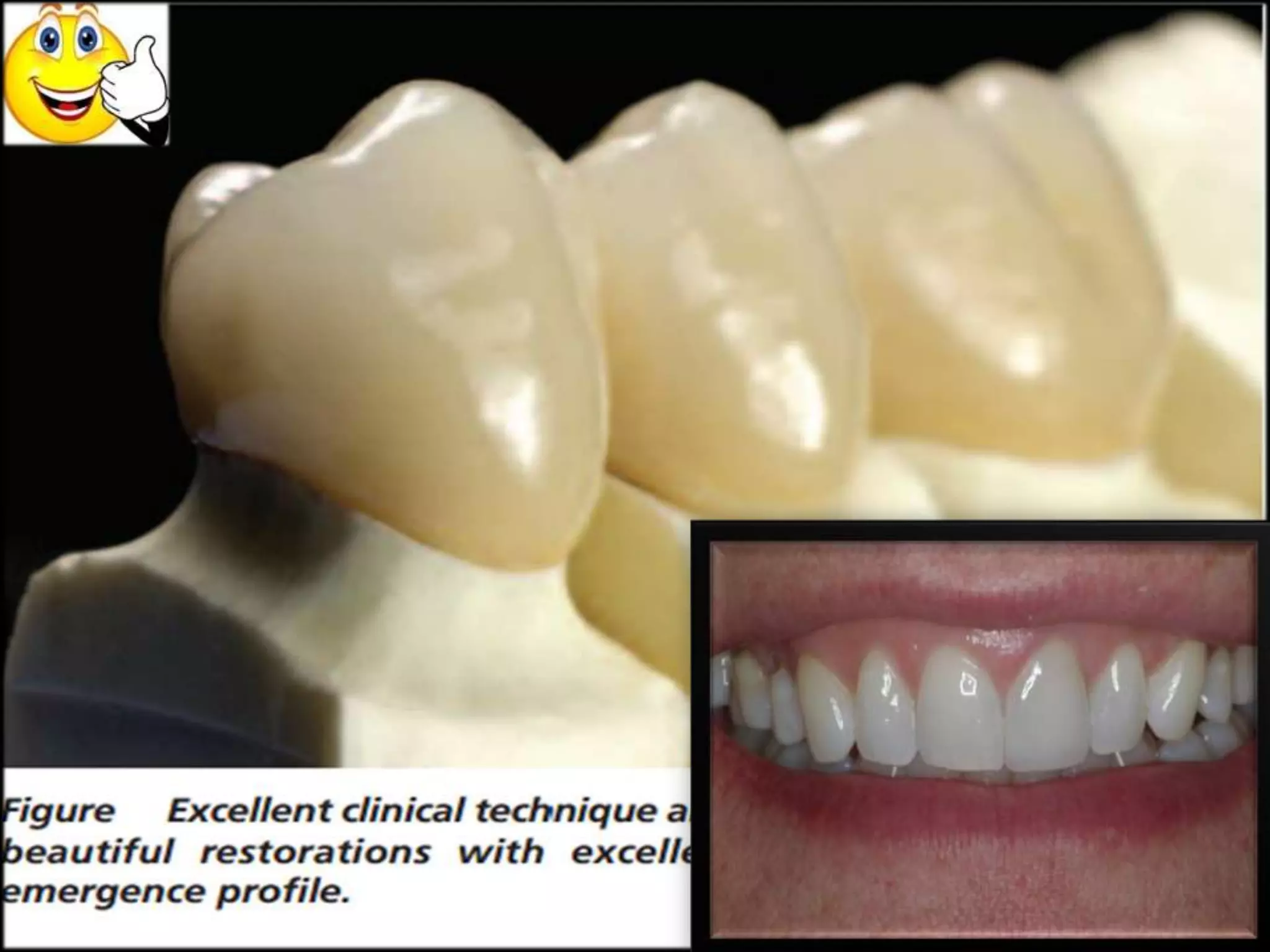 Different gingival finish lines (margins) of crowns and bridges | PPTX