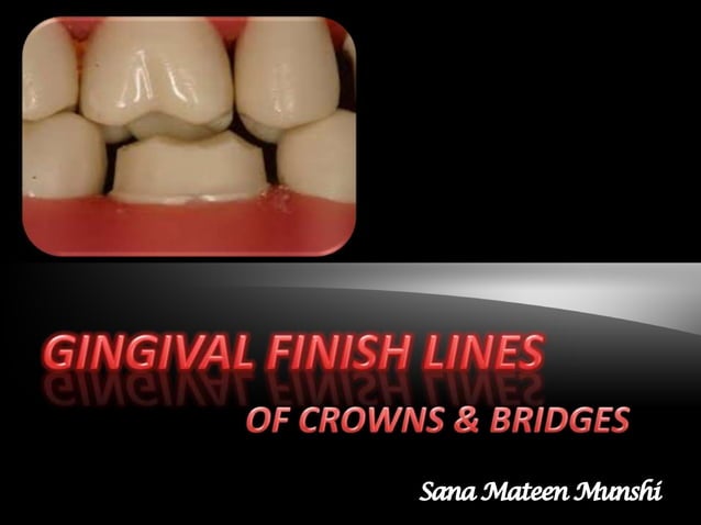 Different gingival finish lines (margins) of crowns and bridges | PPTX