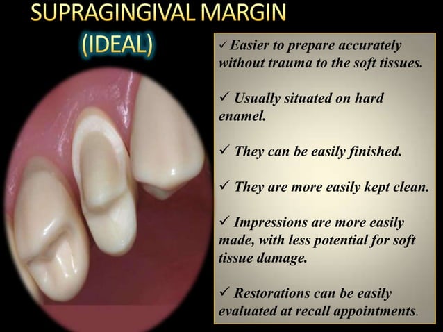 Different gingival finish lines (margins) of crowns and bridges | PPTX