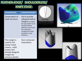 Different gingival finish lines (margins) of crowns and bridges | PPTX