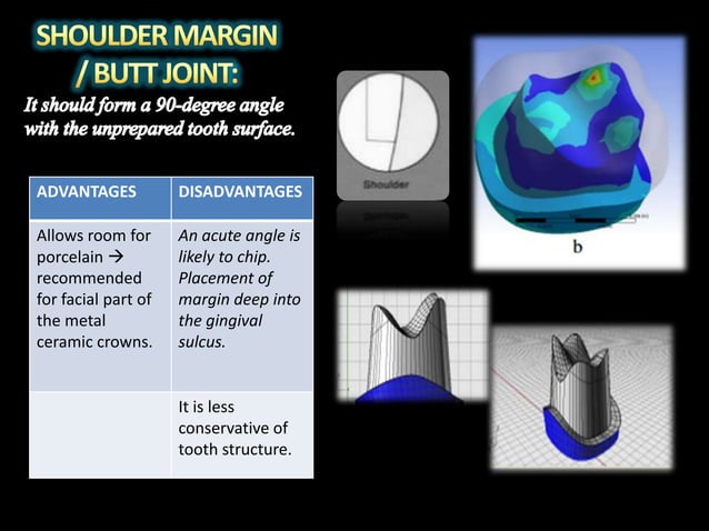 Different gingival finish lines (margins) of crowns and bridges | PPTX