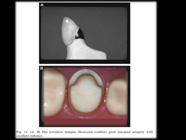 Different gingival finish lines (margins) of crowns and bridges | PPTX