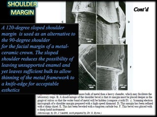Different gingival finish lines (margins) of crowns and bridges | PPTX
