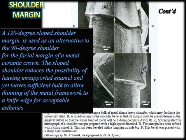 Different gingival finish lines (margins) of crowns and bridges | PPTX