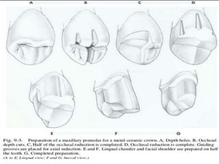 Different gingival finish lines (margins) of crowns and bridges | PPTX