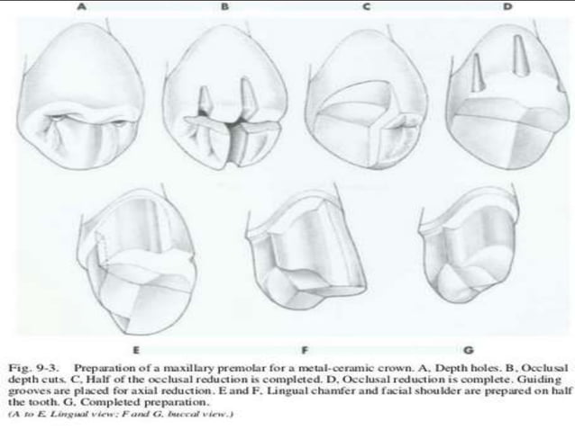 Different gingival finish lines (margins) of crowns and bridges | PPTX