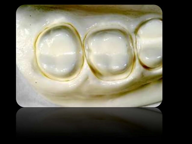Different gingival finish lines (margins) of crowns and bridges | PPTX