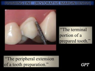 Different gingival finish lines (margins) of crowns and bridges | PPTX