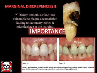 Different gingival finish lines (margins) of crowns and bridges | PPTX