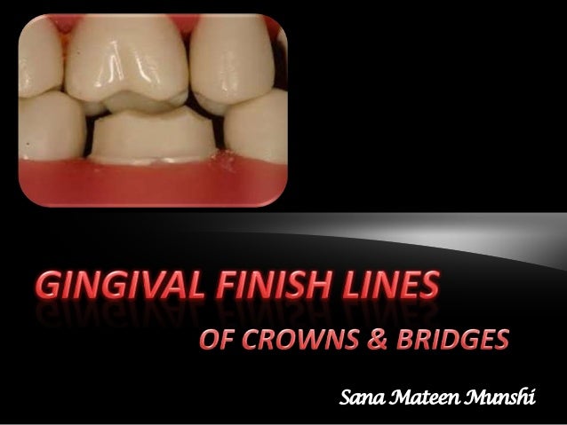 Different gingival finish lines (margins) of crowns and bridges