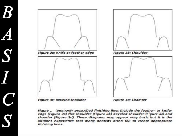 Different gingival finish lines (margins) of crowns and bridges