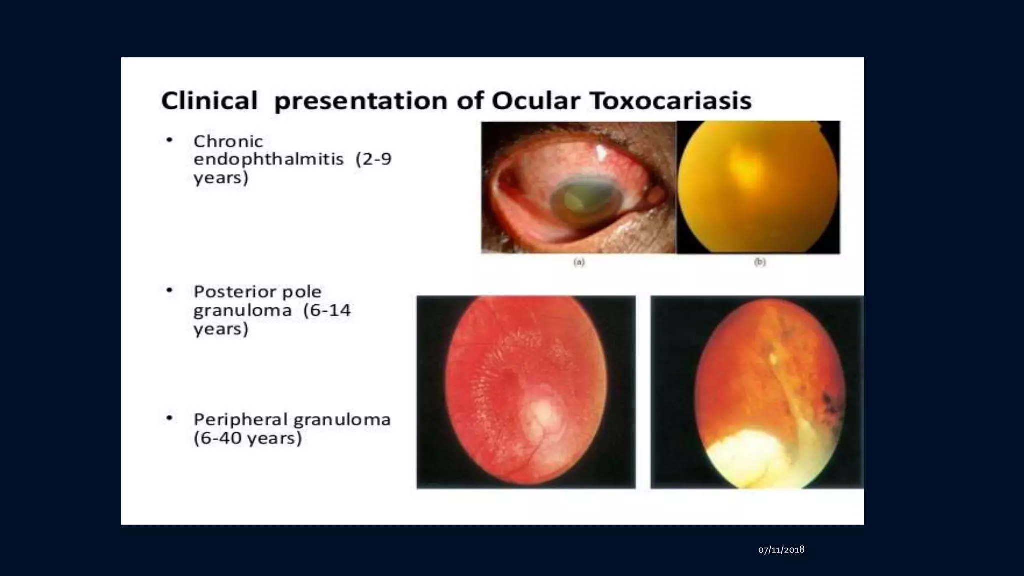 Differential diagnosis of congenital cataract | PPT