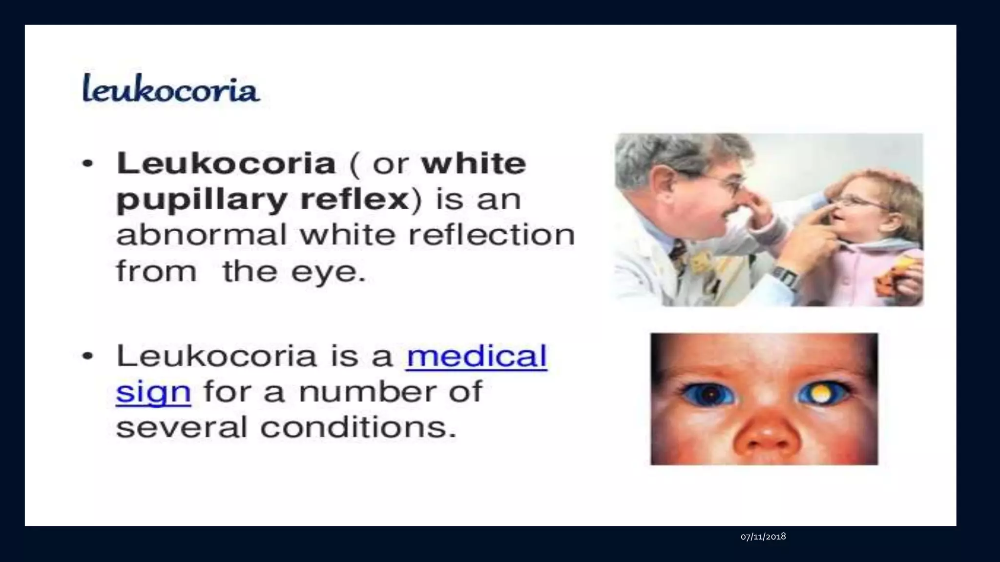 Differential diagnosis of congenital cataract | PPT
