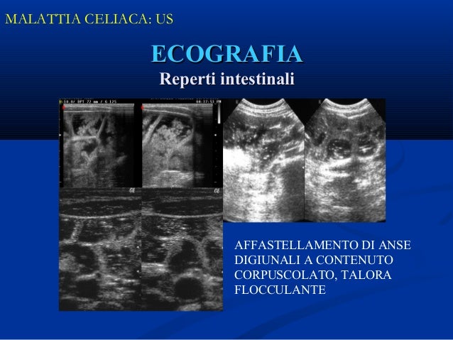 Malassorbimento intestinale possibilità e limiti dell'ecografia