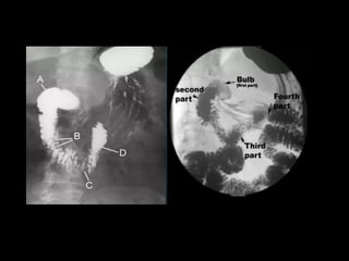 RADIOLOGY OF GIT ,RADIOLOGICAL APPROACH TO GIT .pptx