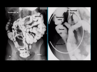 RADIOLOGY OF GIT ,RADIOLOGICAL APPROACH TO GIT .pptx
