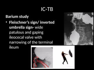 RADIOLOGY OF GIT ,RADIOLOGICAL APPROACH TO GIT .pptx