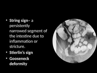 RADIOLOGY OF GIT ,RADIOLOGICAL APPROACH TO GIT .pptx