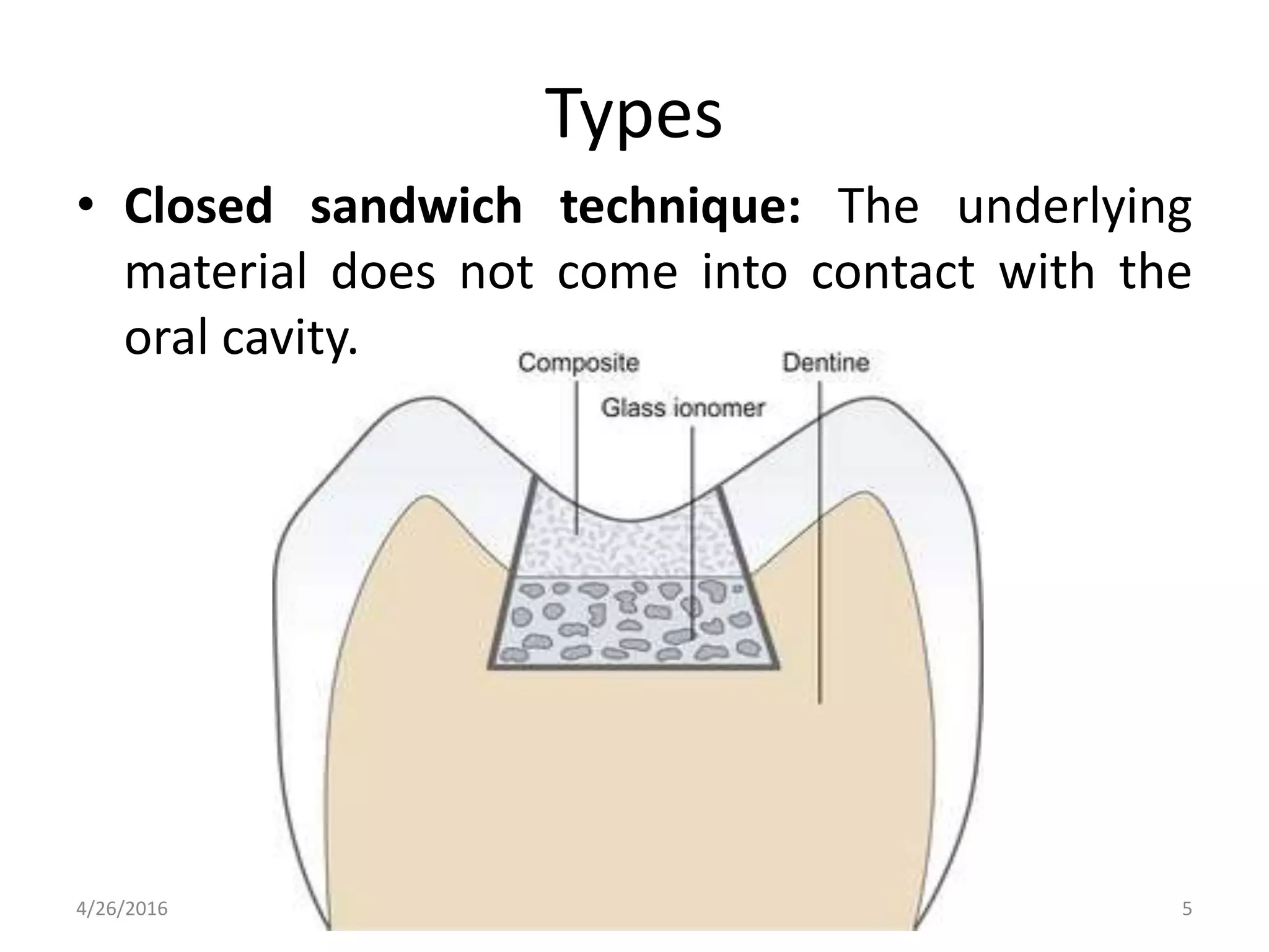 Sandwich technique | PPTX