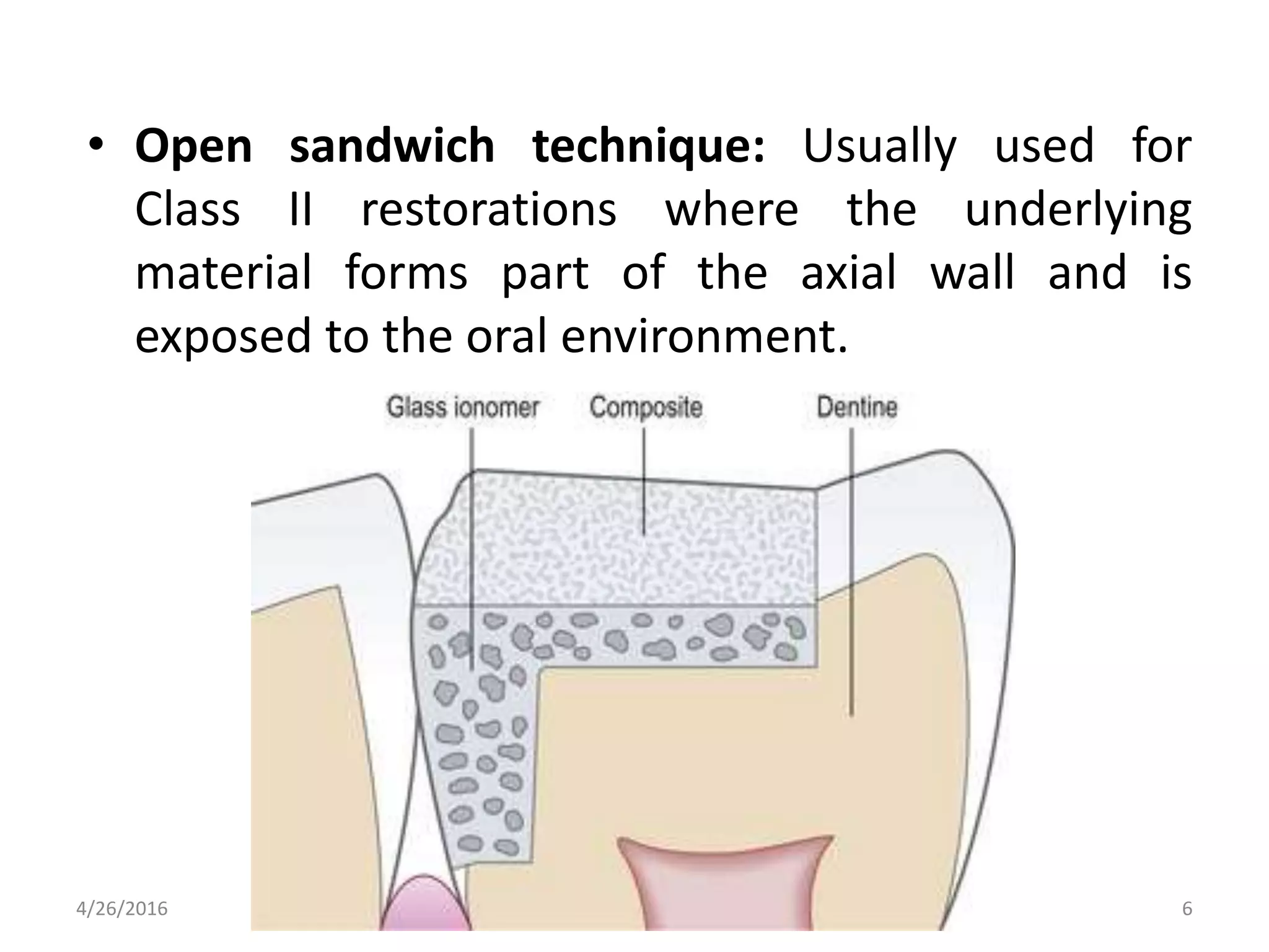 Sandwich technique | PPTX