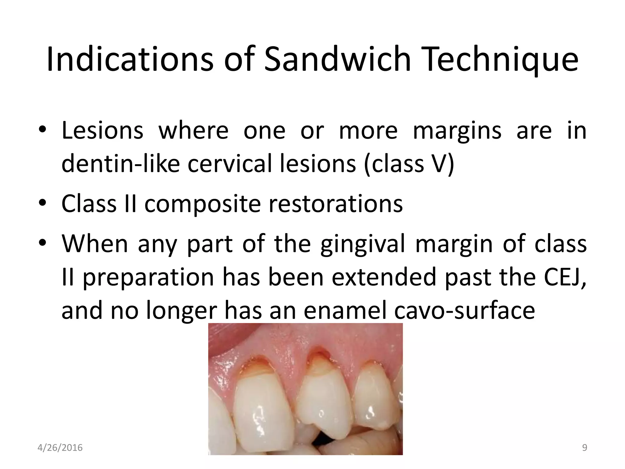 Sandwich technique | PPTX
