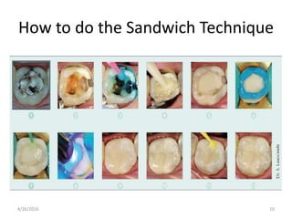 Sandwich technique | PPTX