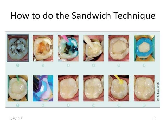 Sandwich technique | PPTX