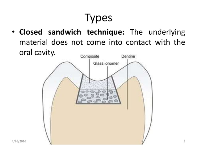 Sandwich technique | PPTX