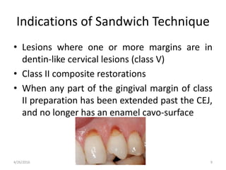 Sandwich technique | PPTX