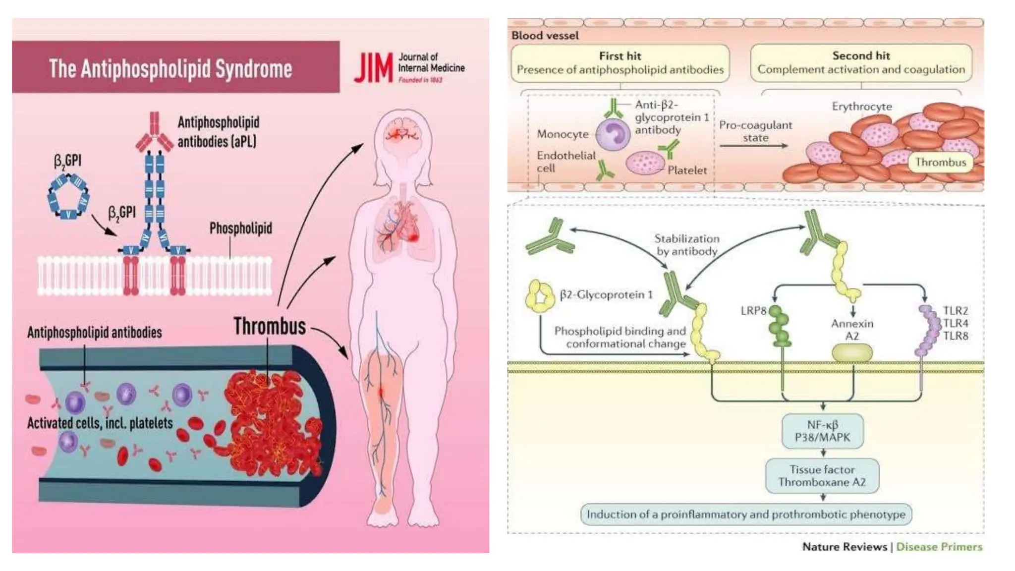 Left homonymous hemianaopia secondary to primary apla | PPTX | Blood ...
