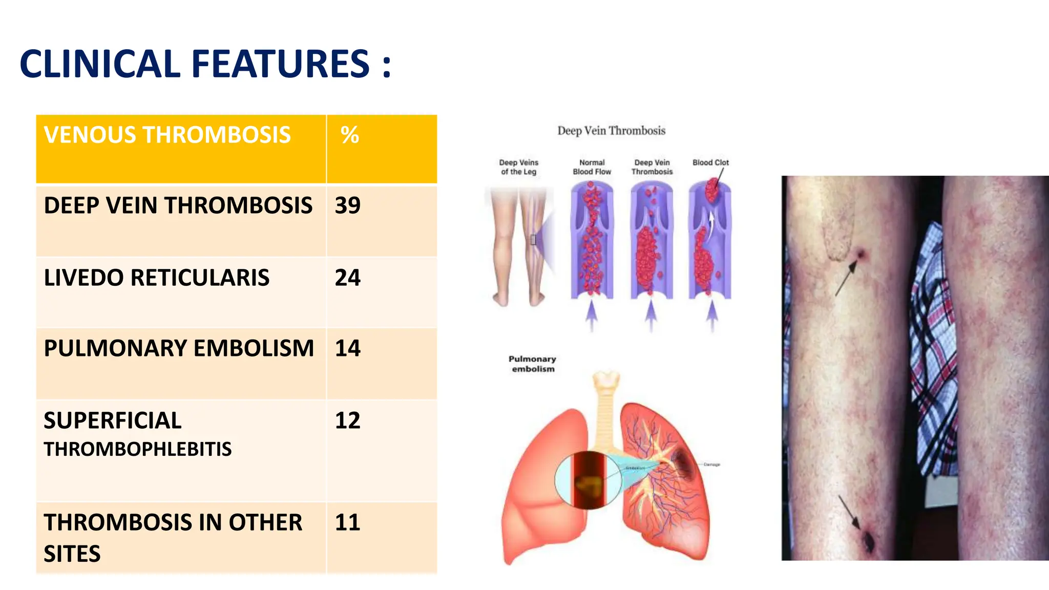 Left homonymous hemianaopia secondary to primary apla | PPTX
