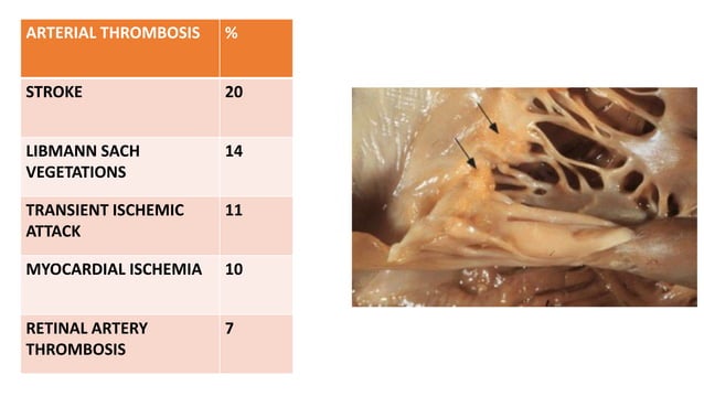 Left homonymous hemianaopia secondary to primary apla | PPT